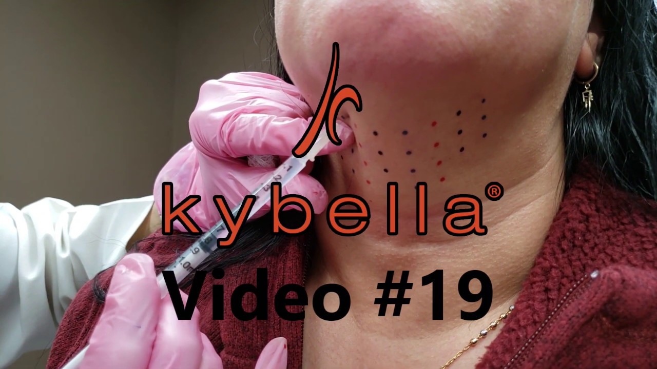 Kybella® injections * Video 🎥 #19 - YouTube