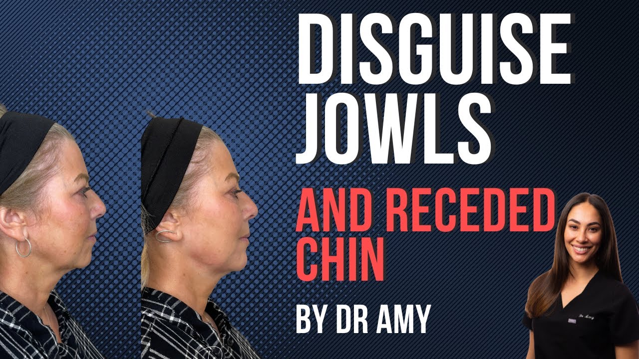 How to get that Defined Side Profile and Disguise Jowls Non-Surgically ...
