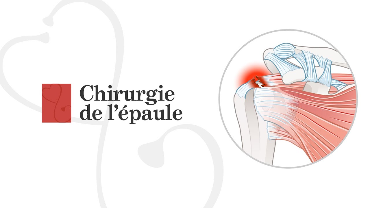 Déroulement complet d'une chirurgie de l'épaule avec Lacroix Chirurgie ...