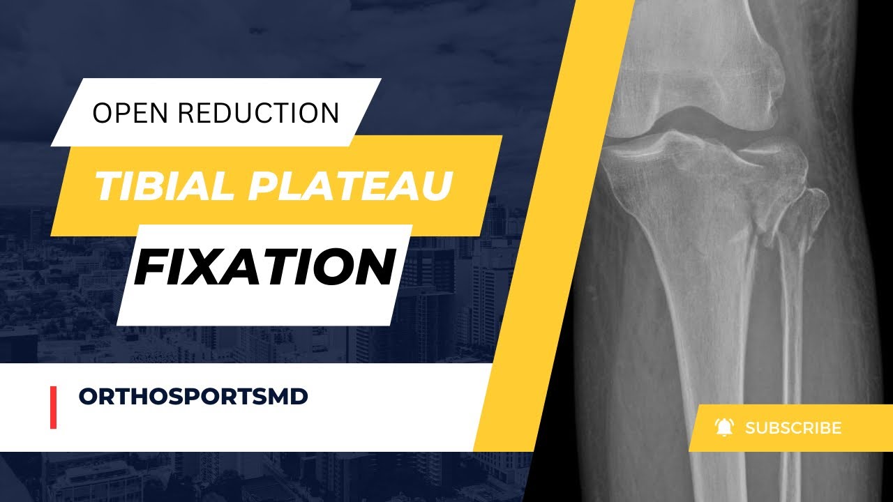 How to fix a tibial plateau fracture | a step by step approach - YouTube
