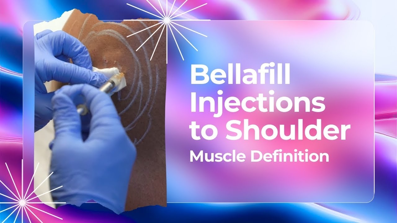 Bellafill Injections to Shoulder | Muscle Definition | West Hollywood ...