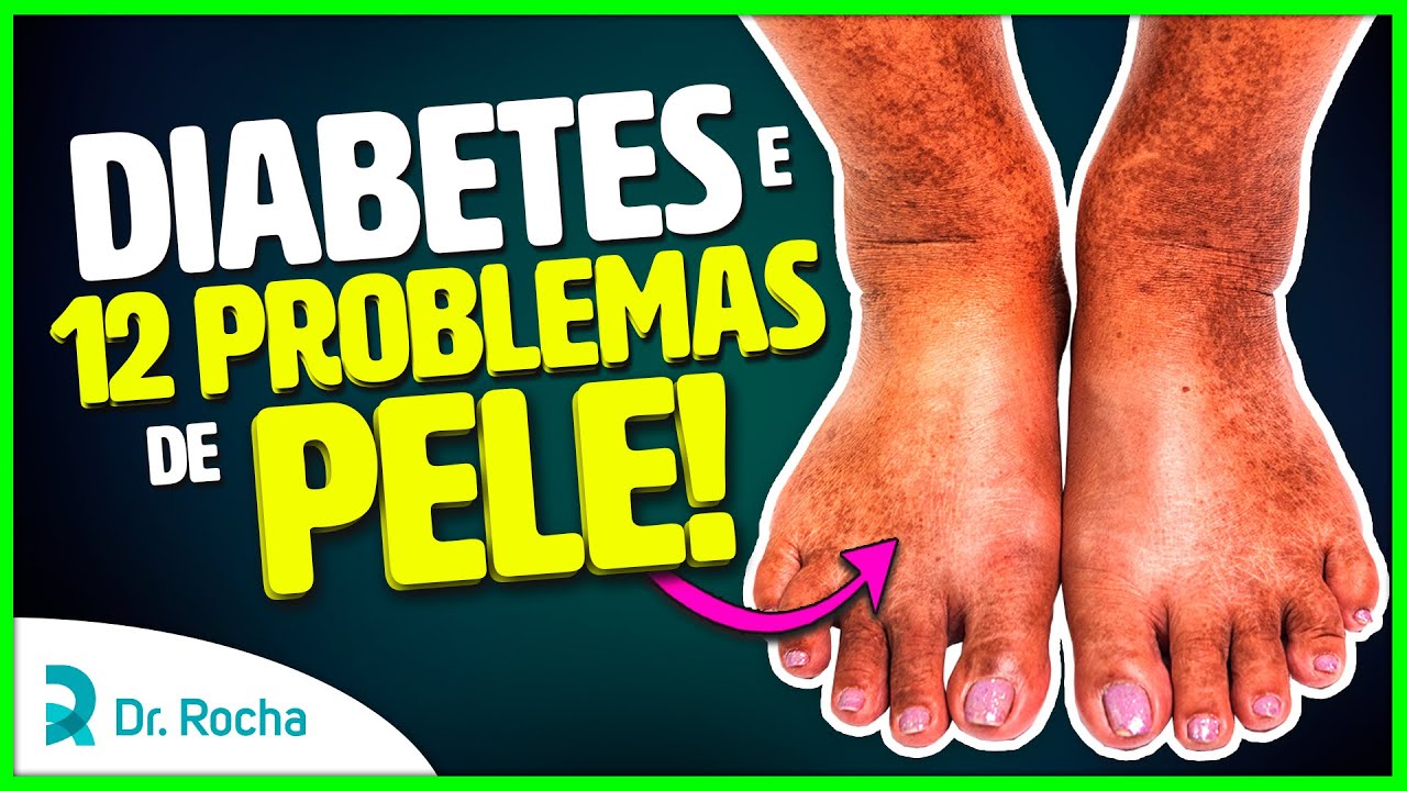 Bolhas Diabeticas Kit Diabet Spa 12 Em 1 Ortho Pauher