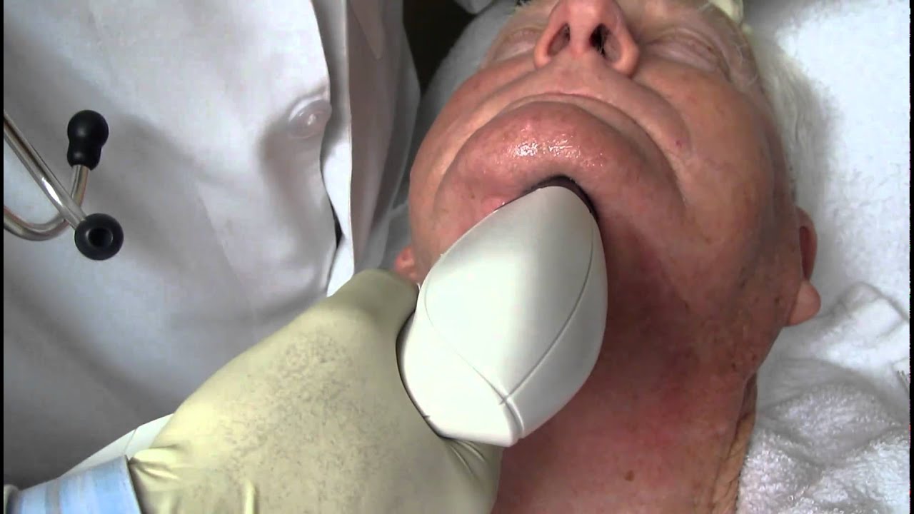 Facial Skin Tightening using Viora Reaction RF CORE - YouTube