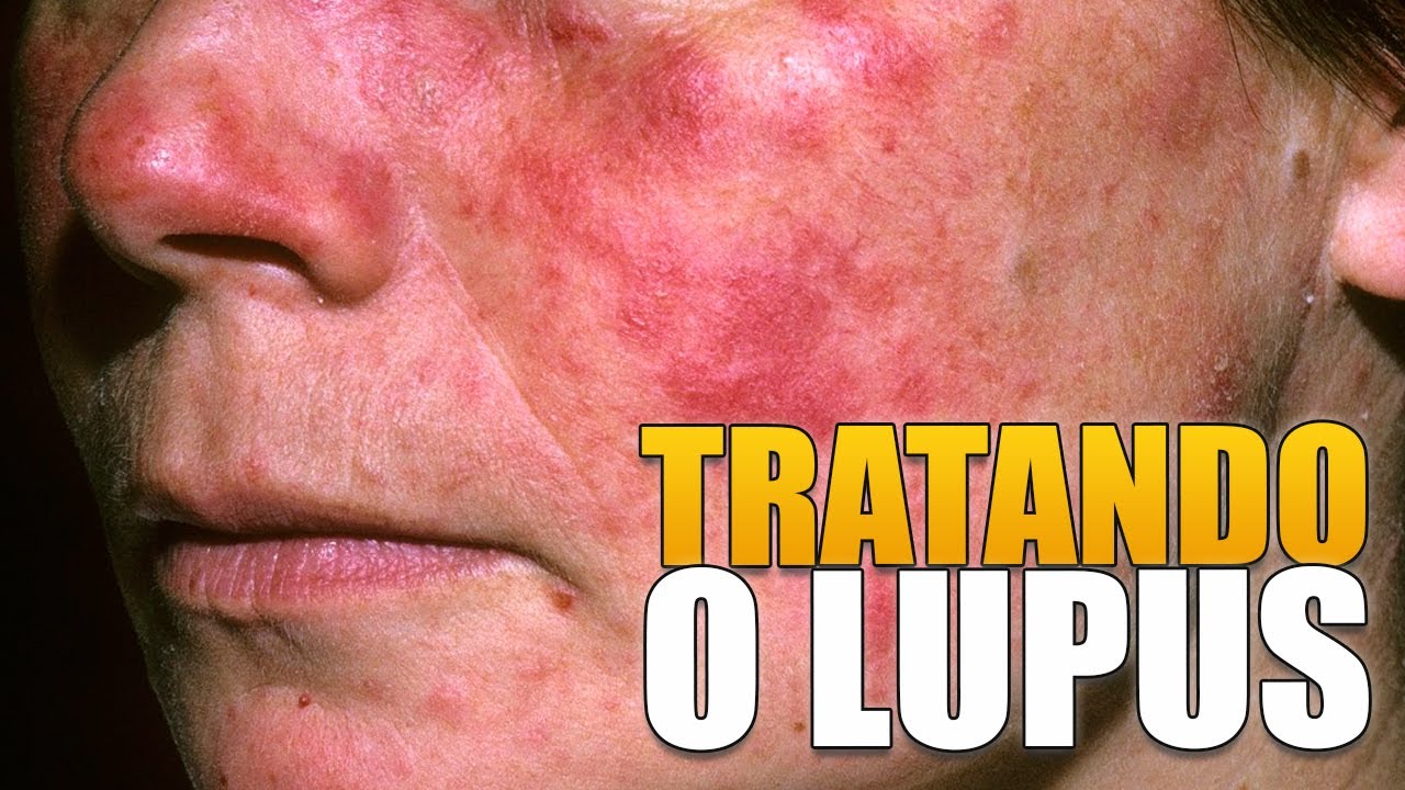 CONHEÇA O LUPUS E O QUE FAZER - YouTube