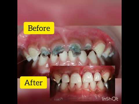 Treatment of Grossly Decayed Baby Tooth Under General Anesthesia ...