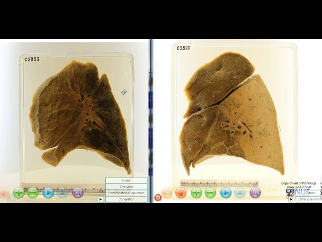 Bronchopneumonia Vs Lobar Pneumonia
