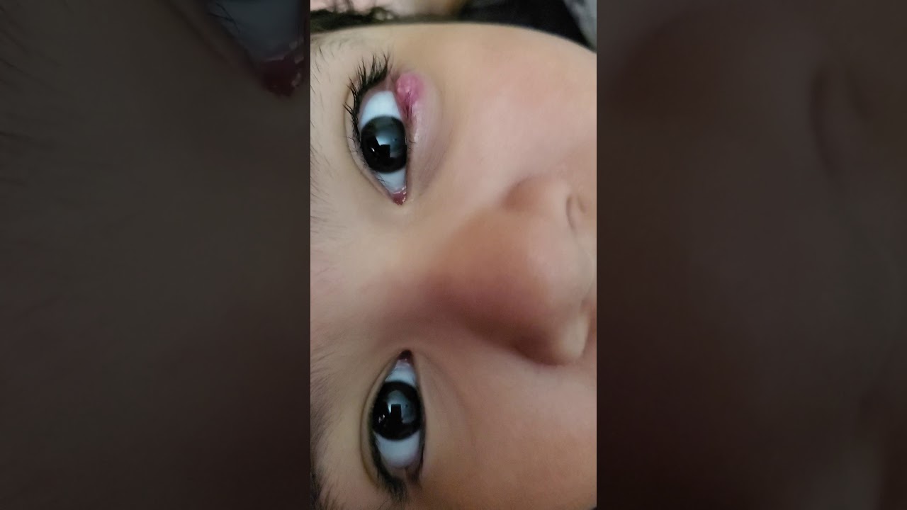 Biggest popping eyes sty attempt day 4 for educational purposes. Stop ...