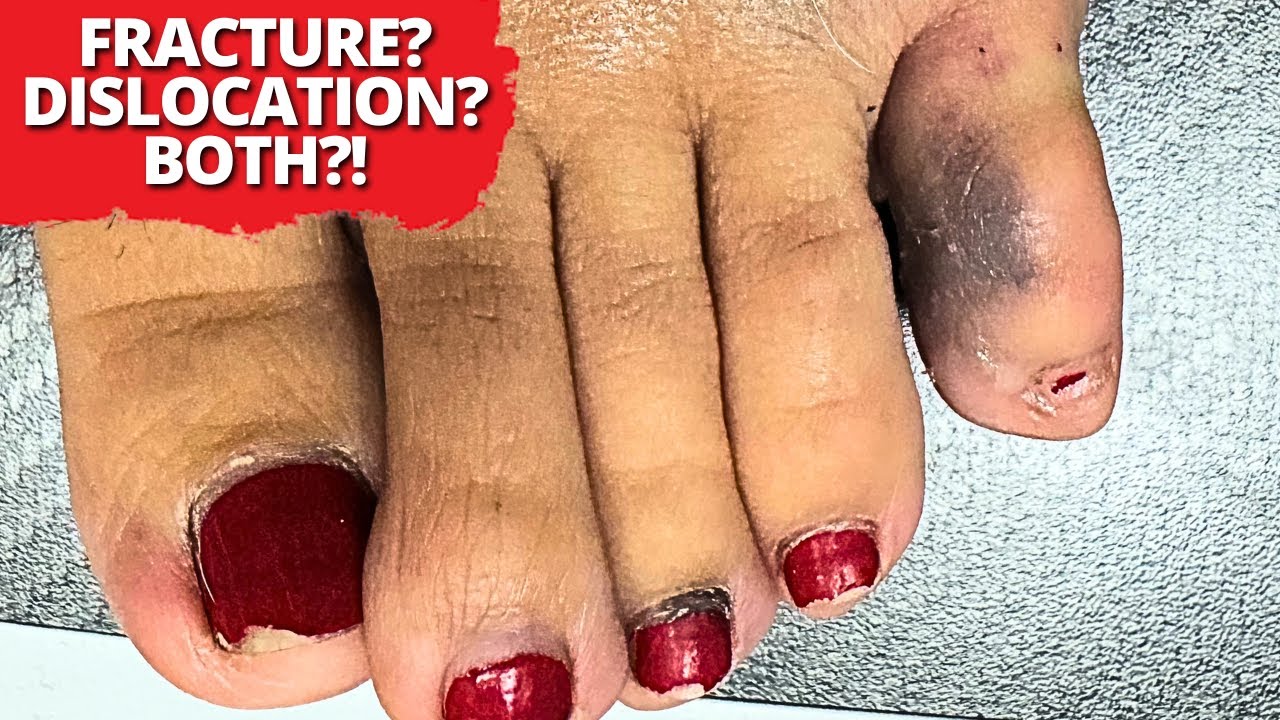Broken AND Dislocated Toe – Here’s What Happened - YouTube