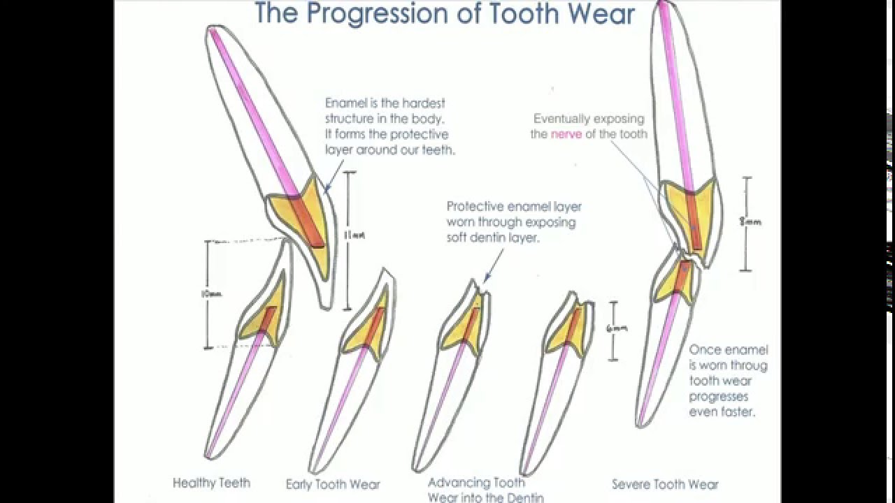 Tooth Wear and Tooth Erosion - Dr George Olstein Dentist Melbourne ...