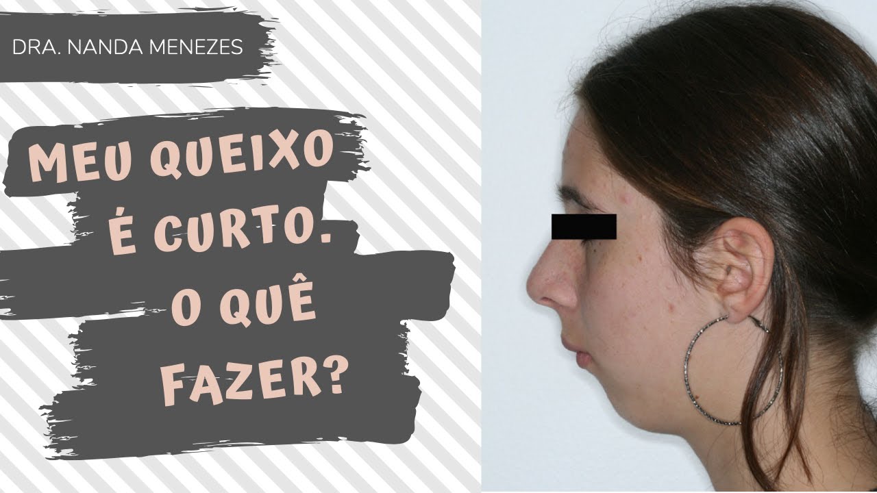 Seu queixo é curto? Pode ser Classe 2 | Dra Nanda Menezes - YouTube