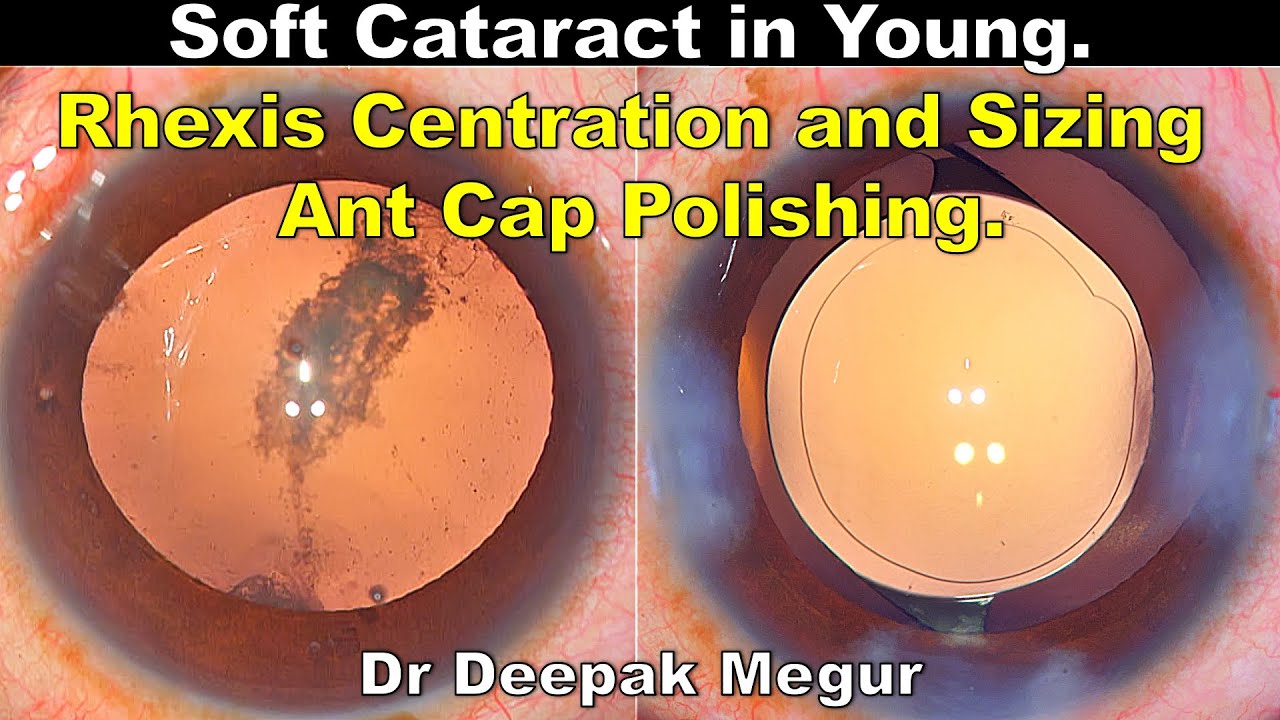 Soft Cataract in Young. Rhexis Centration and Sizing, Anterior Capsule ...