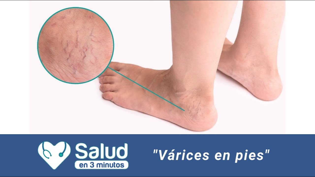 Salud en 3 Minutos: Várices en los pies - YouTube