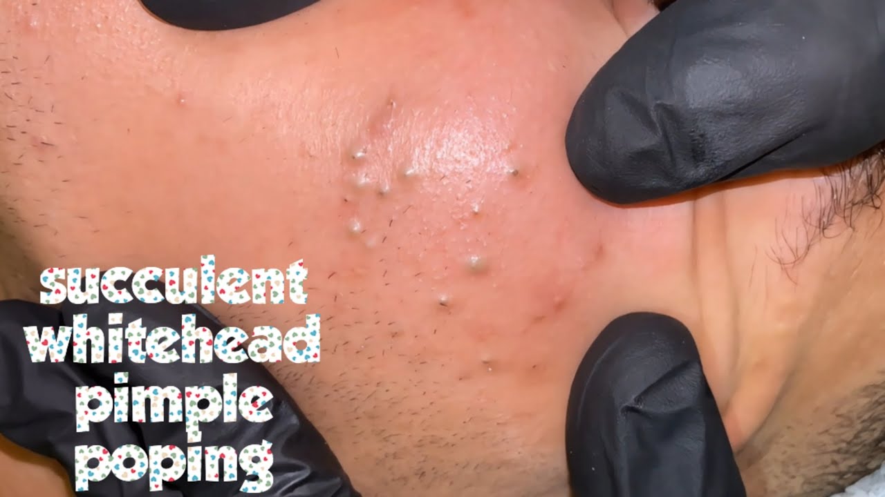 satisfy succulent whitehead pimple popping. #fypviral #whiteheads # ...