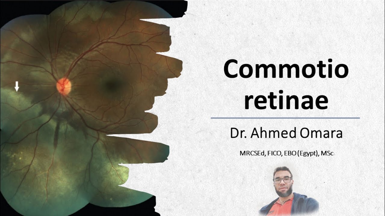 19 Wills eye manual - Commotio retinae (Arabic narration) - YouTube