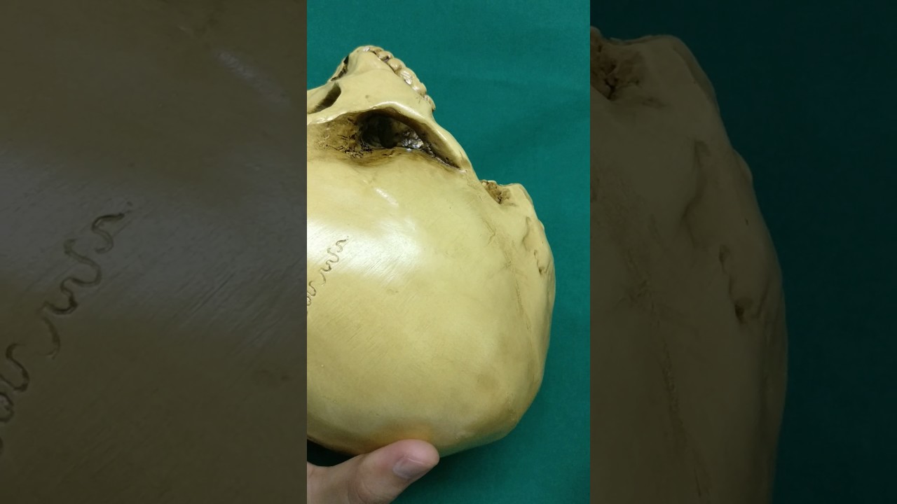 Rowe's zygoma elevator - YouTube