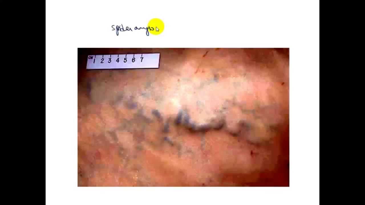 Liver Pathology - Cirrhosis - Pathogenesis of clinical features ...