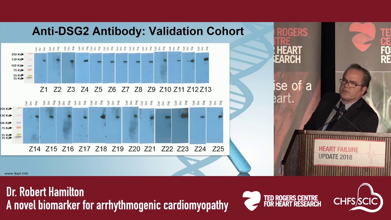 Dr. Robert Hamilton: A novel biomarker for arrhythmogenic ...