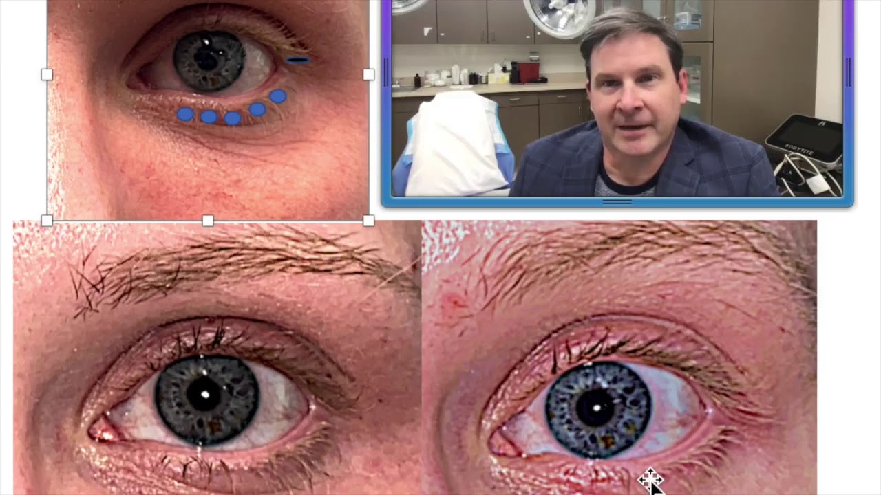 Cosmetic Skin Pinch Blepharoplasty Canthopexy Surgery at Springs ...