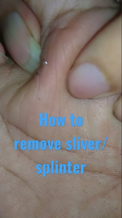 How to remove sliver or splinter - YouTube