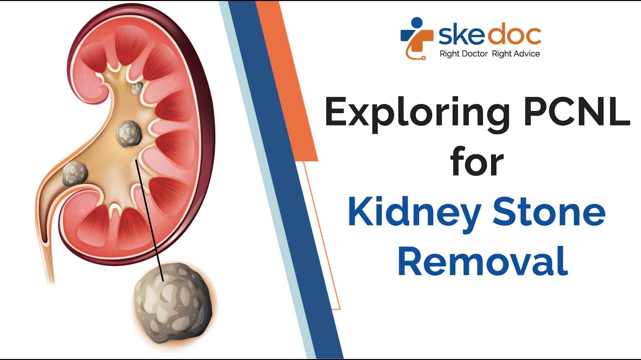 Exploring PCNL for Kidney Stone Removal | Skedoc - YouTube