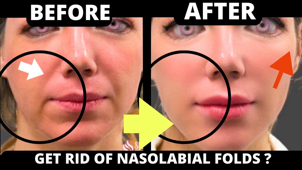 HOW TO GET RID OF NASOLABIAL FOLDS WITH FACE YOGA ? JOWLS, SAGGY SKIN ...