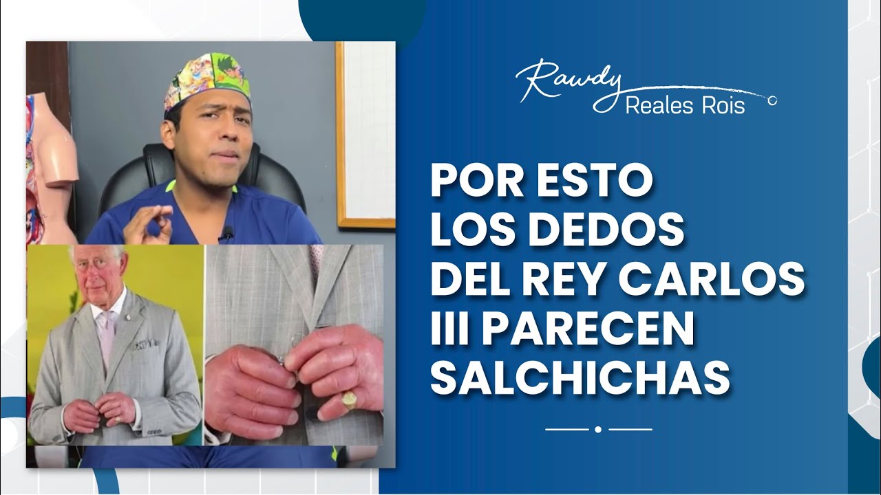 LOS DEDOS DEL REY CARLOS III | DR. RAWDY - YouTube