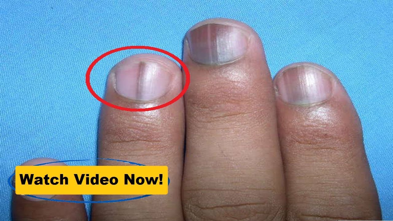If You See A Black Line On A Person s Fingernail Run And Call If You See A Black Line On A Person s Fingernail Run And Call