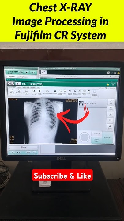 Chest X-ray Image Processing #xray #FujifilmCRsystem #Chestxray #radiographerusn - YouTube