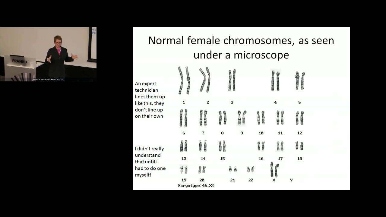 Wolf Hirschhorn syndrome and 4p disorders history and pathophysiology ...