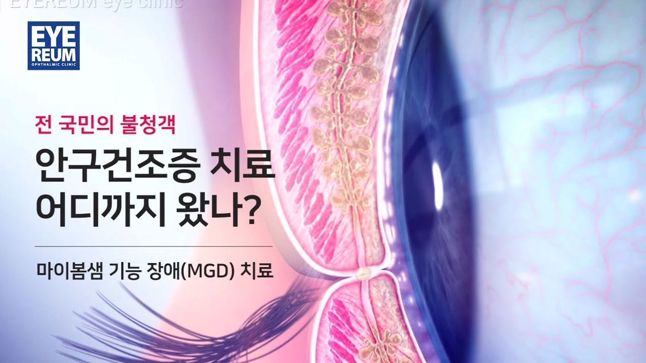 [아이리움안과] IPL 레이저를 이용한 마이봄샘 기능 장애(MGD) 치료 - YouTube