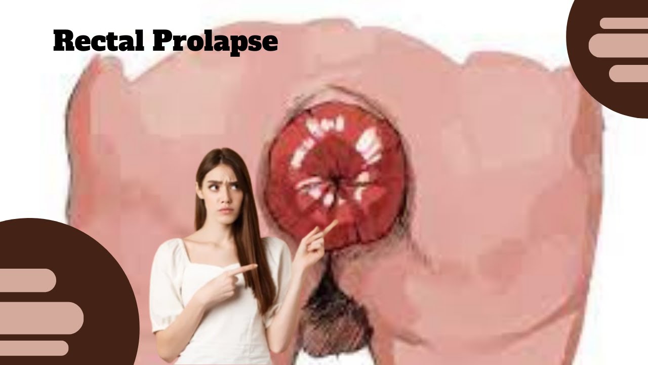 How to treat rectal prolapse without surgery | कैसे करें रेक्टल प्रोलैप्स का बिना सर्जरी द्वारा ...