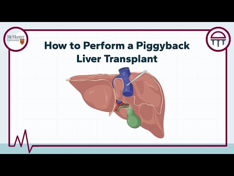 How to Perform a Piggyback Liver Transplant