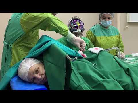 Onurğa disk yırtığı (qrijası ) operasiyasi. Neyrocərrah Əliosman Qədimbəyli