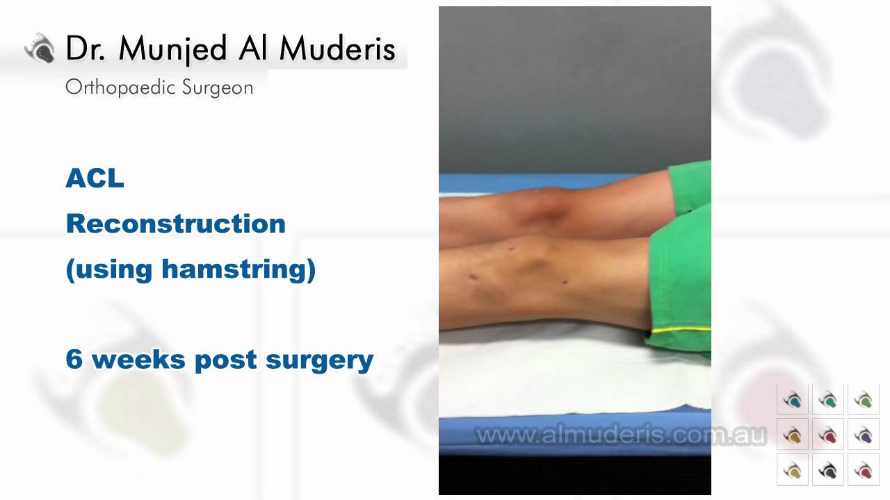 ACL Reconstruction using hamstring - 6 weeks post surgery - YouTube