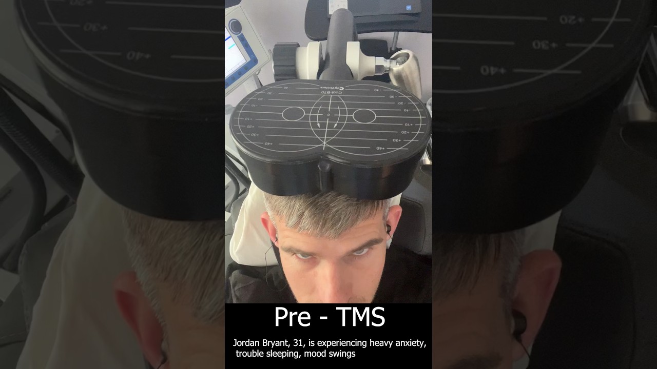 TMS therapy before and after 40 sessions - YouTube
