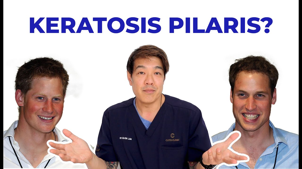 Keratosis Pilaris | How to treat by dermatologist Dr Davin Lim - YouTube