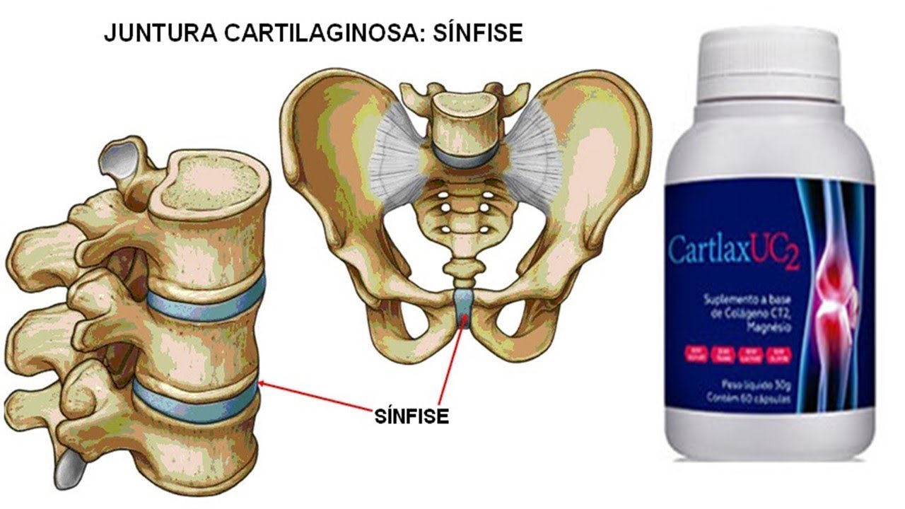 Cartilax Colágeno uc2 e o Remédio para a Cura da Artrite, Artrose e nas ...