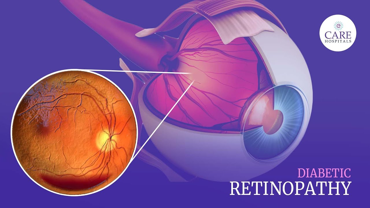What is Diabetic Retinopathy? - YouTube
