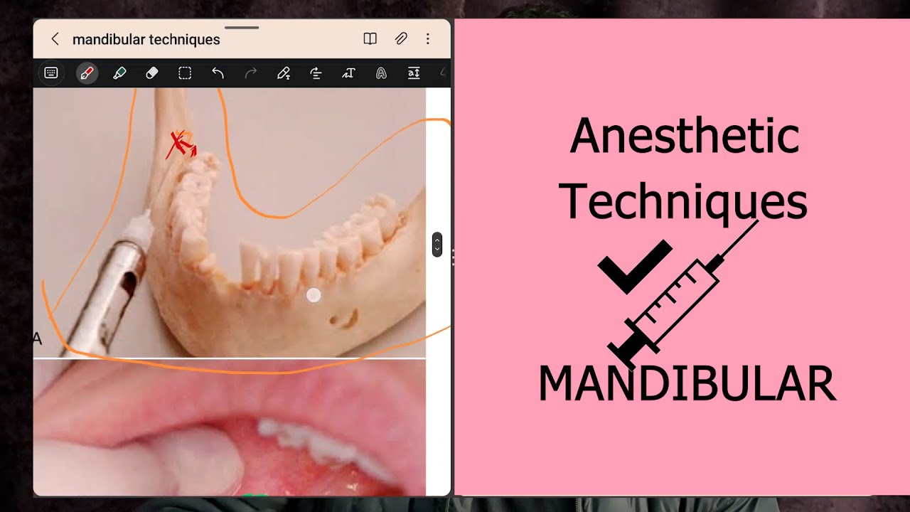 Anesthetic Techniques MANDIBULAR - YouTube