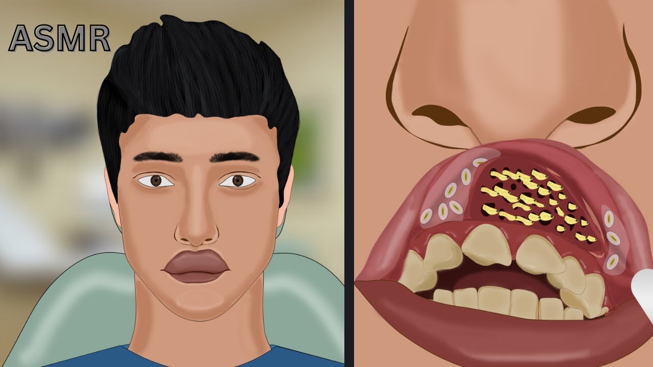 [ASMR | 스톱모션] 입안에서 발견되는 벌레 구더기 제거 | Remove botfly maggots found inside ...