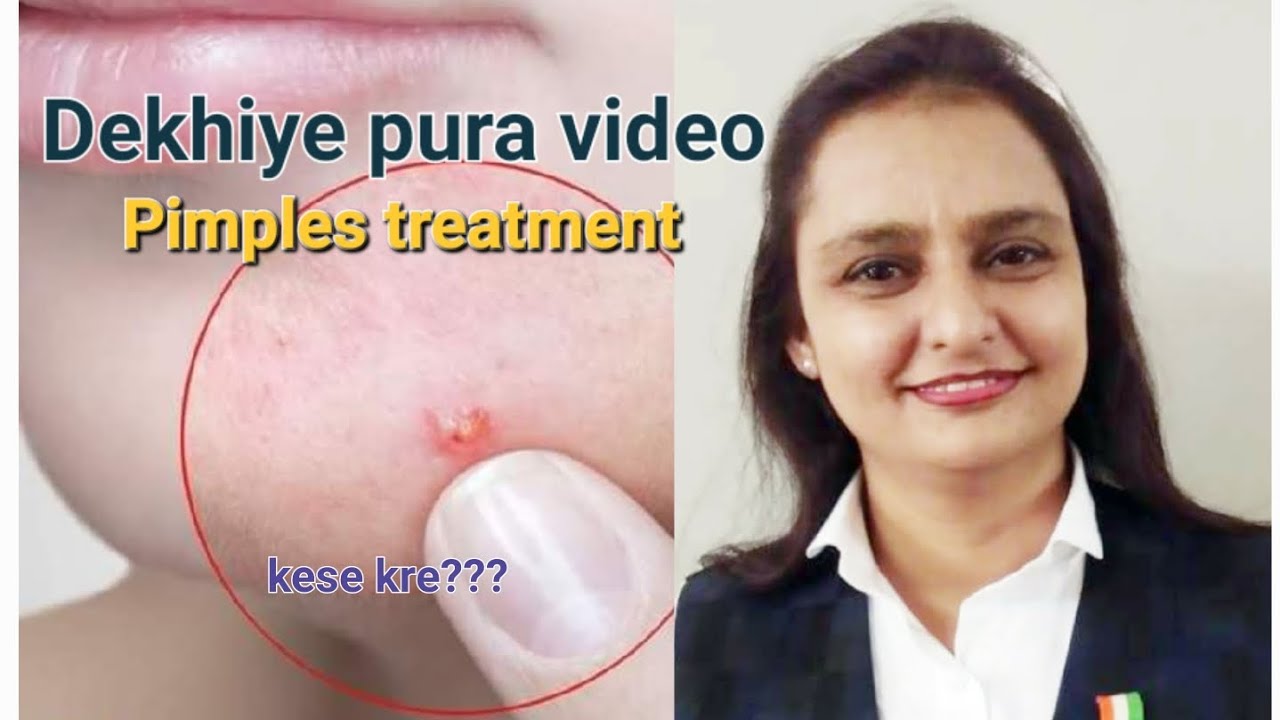 Pimples treatment || Pimples ko thik kese kre? || Pimple ki treatment ...