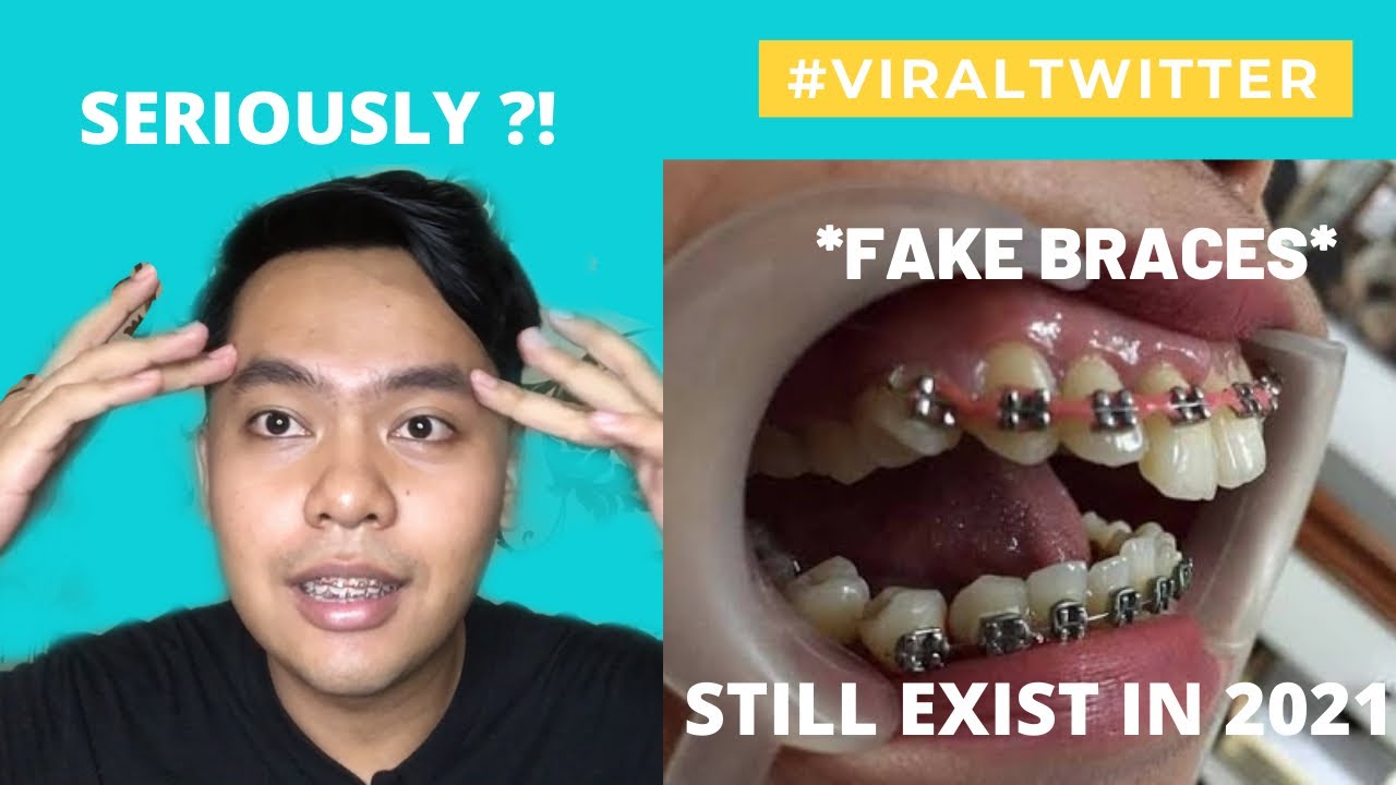 *FAKE BRACES 2021* *REAL DI MALAYSIA* Seram Tengok Gigi Mangsa 😱😭 ...