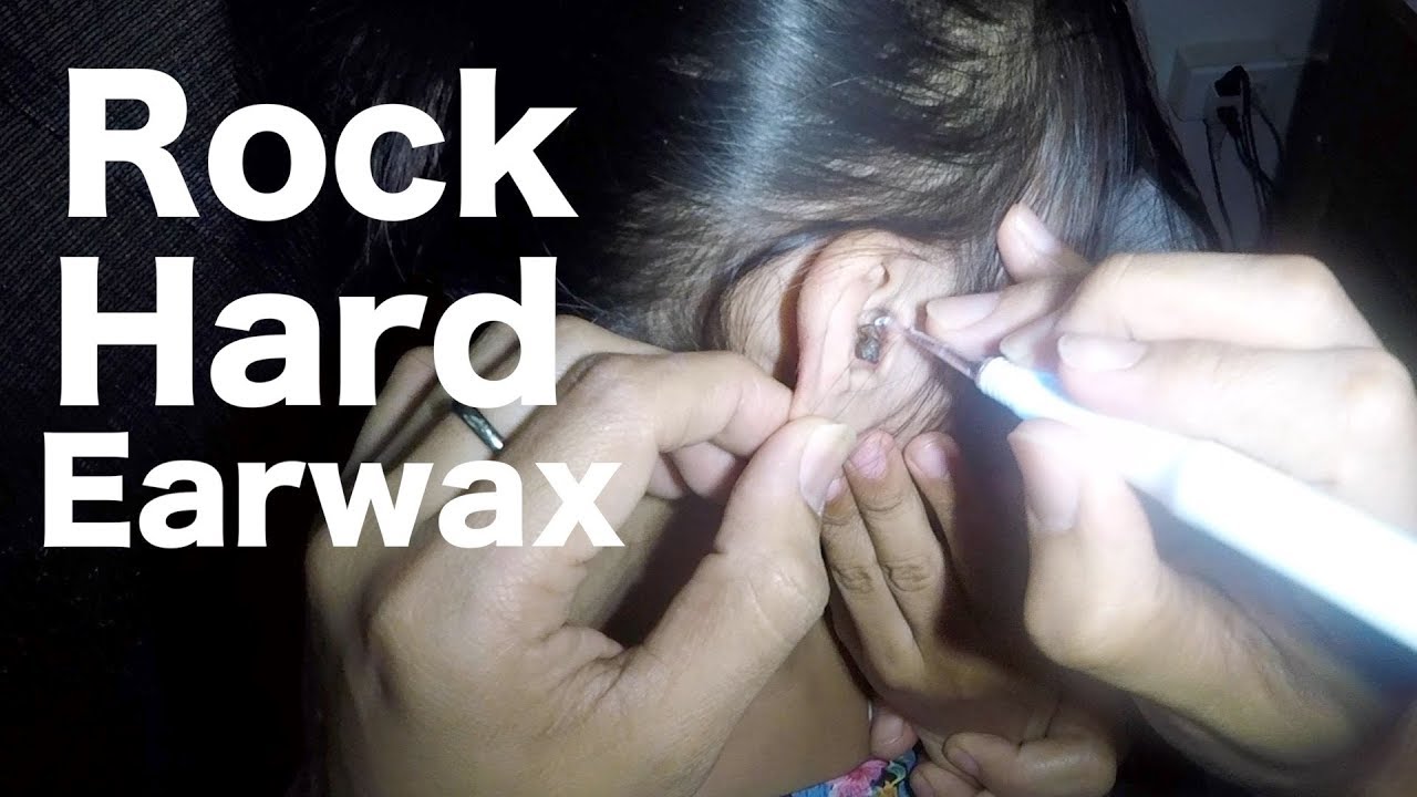 Little Girl's Rock-Hard Earwax Removal with Hydrogen Peroxide - YouTube