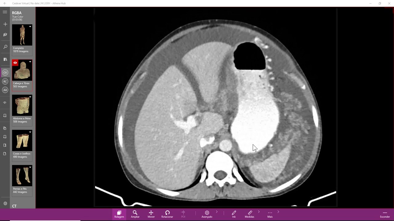 Tumor gástrico com carcinomatose peritoneal - YouTube