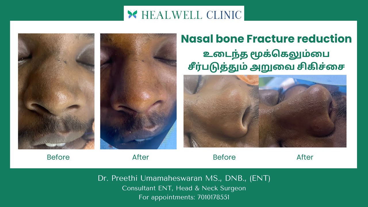 Nasal bone Fracture reduction - YouTube