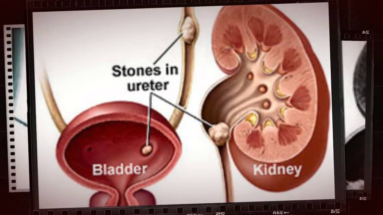 Renal Calculi Symptoms And Causes YouTube