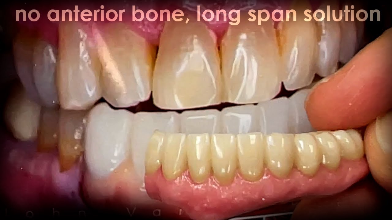Long Span Solution for Patient With No Anterior Bone - YouTube