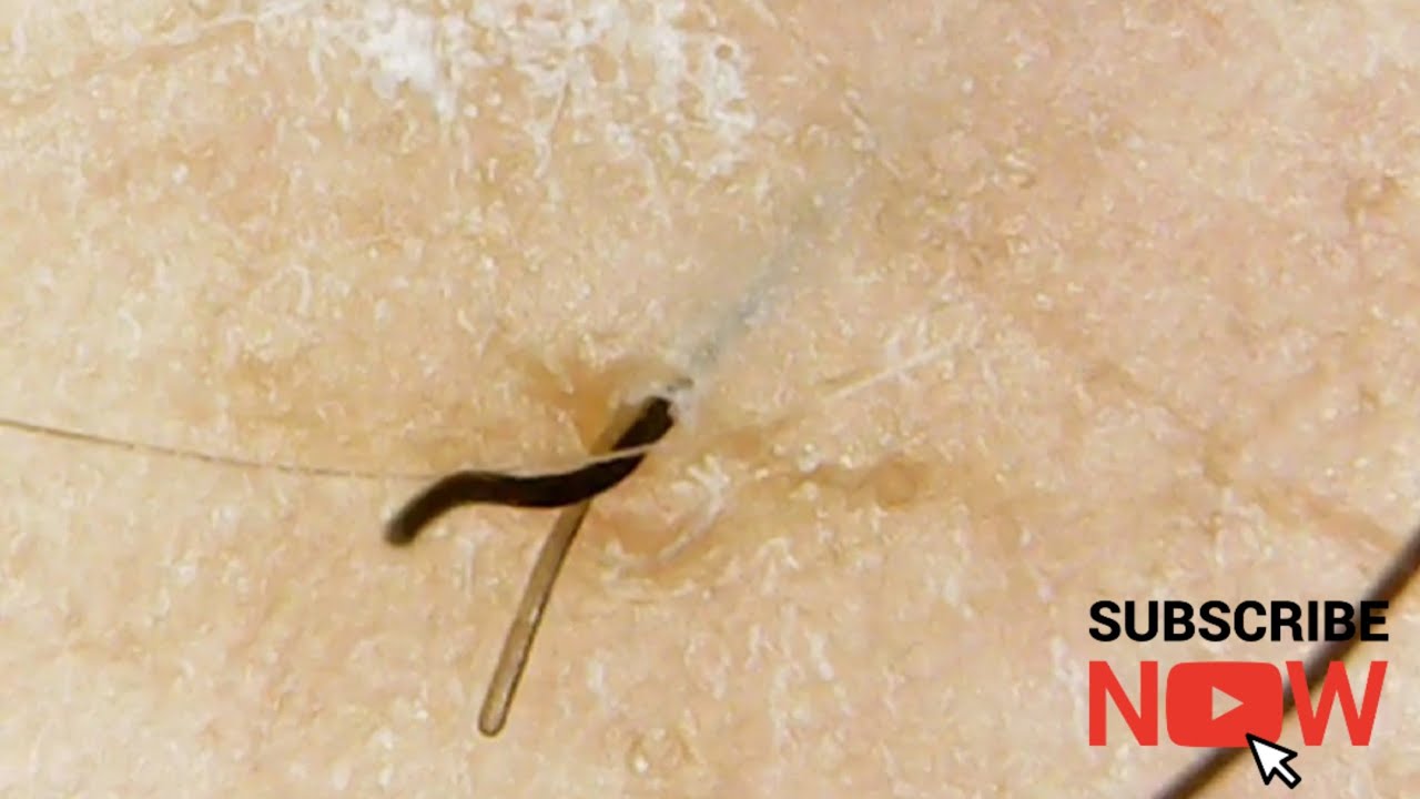 Hair Extraction|TwinHairs| Satisying×short video - YouTube