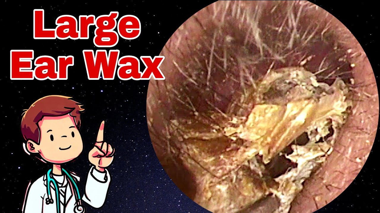 Large Ear Wax Removal From Both Ears | Doctor Anh - YouTube