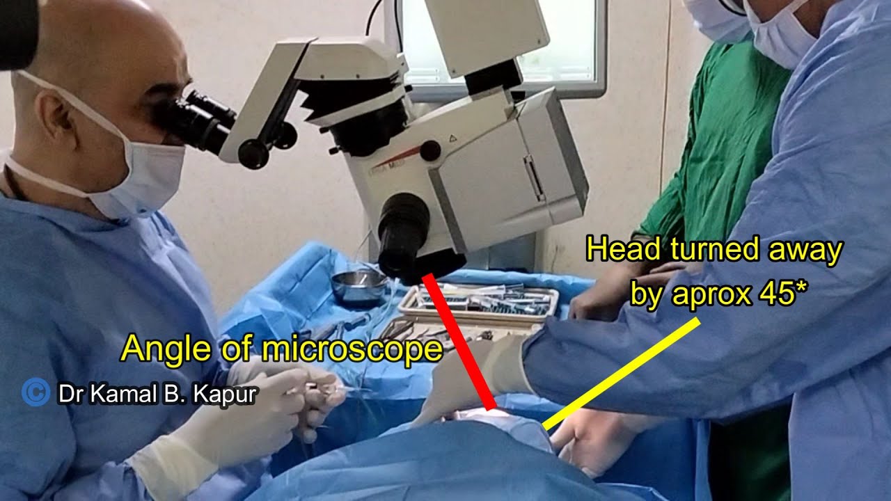 BANG-Bent Ab interno needle goniectomy-(learning MIGS-1) | Dr Kamal B ...